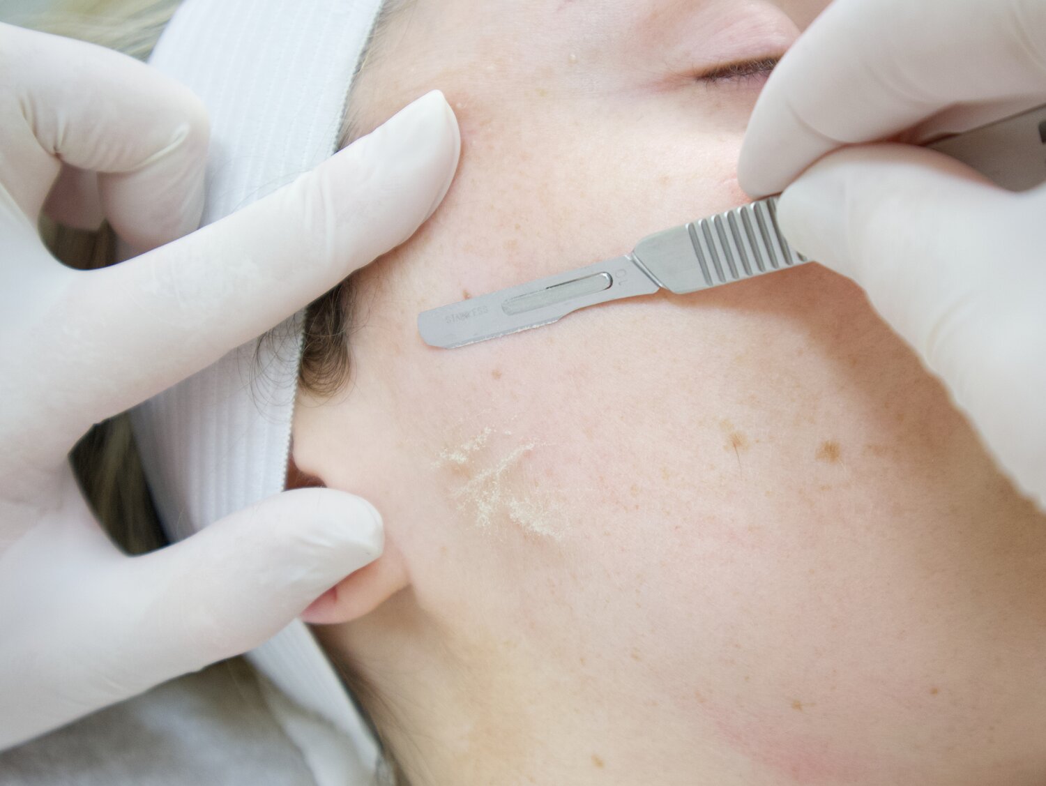 Epidermal Leveling – Artemis Medispa