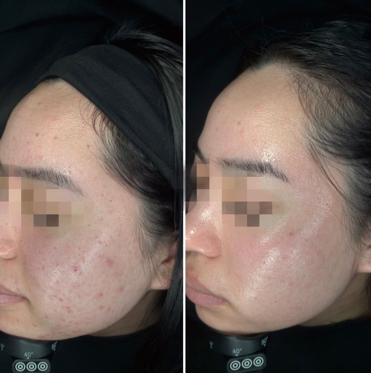 Acnelan® acne medical treatment – Artemis Medispa